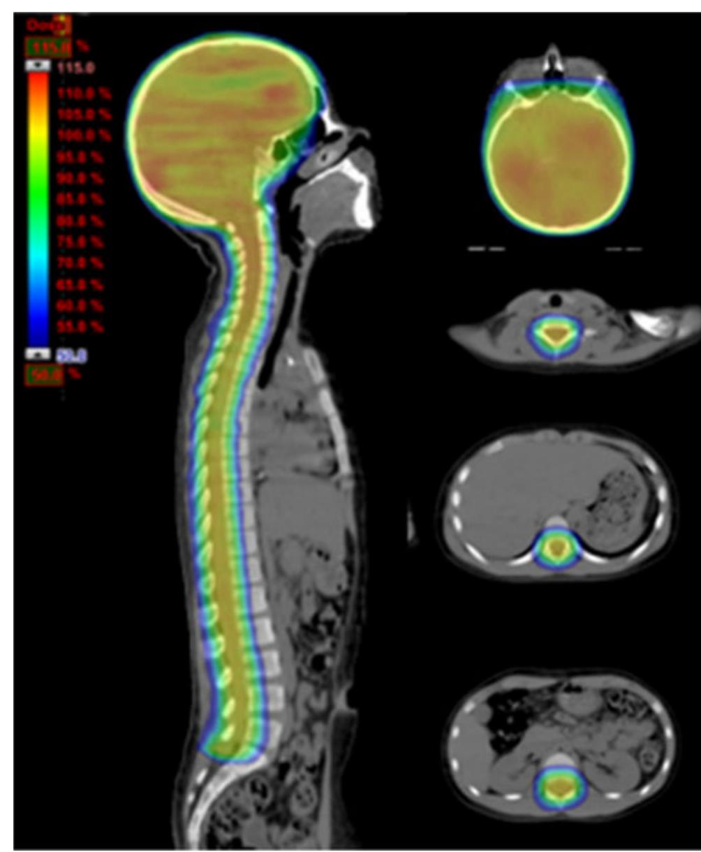 Dose distribution (sagittal and axial slices) for patient a.