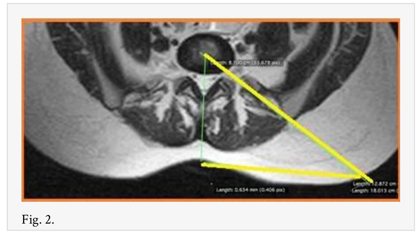 Light sedation and local anesthetic infiltration of the