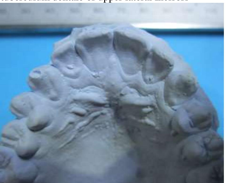 (11): a photograph of dental cast showing canine mesial