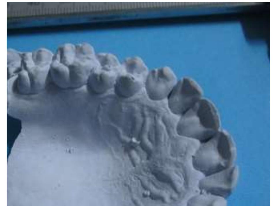 (12): a photograph of dental cast showing canine distal