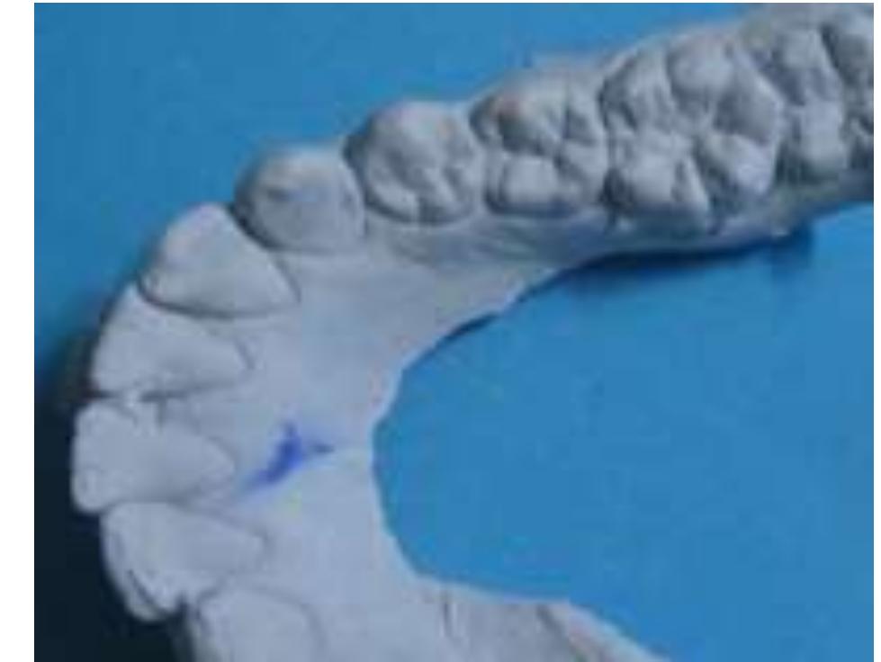 (17): a photograph of dental cast showing lower premolars