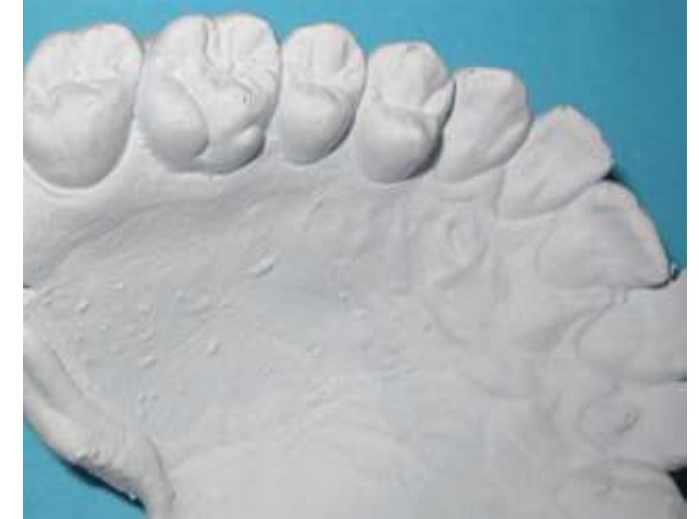 (15): a photograph of dental cast showing carabelli’s cusp