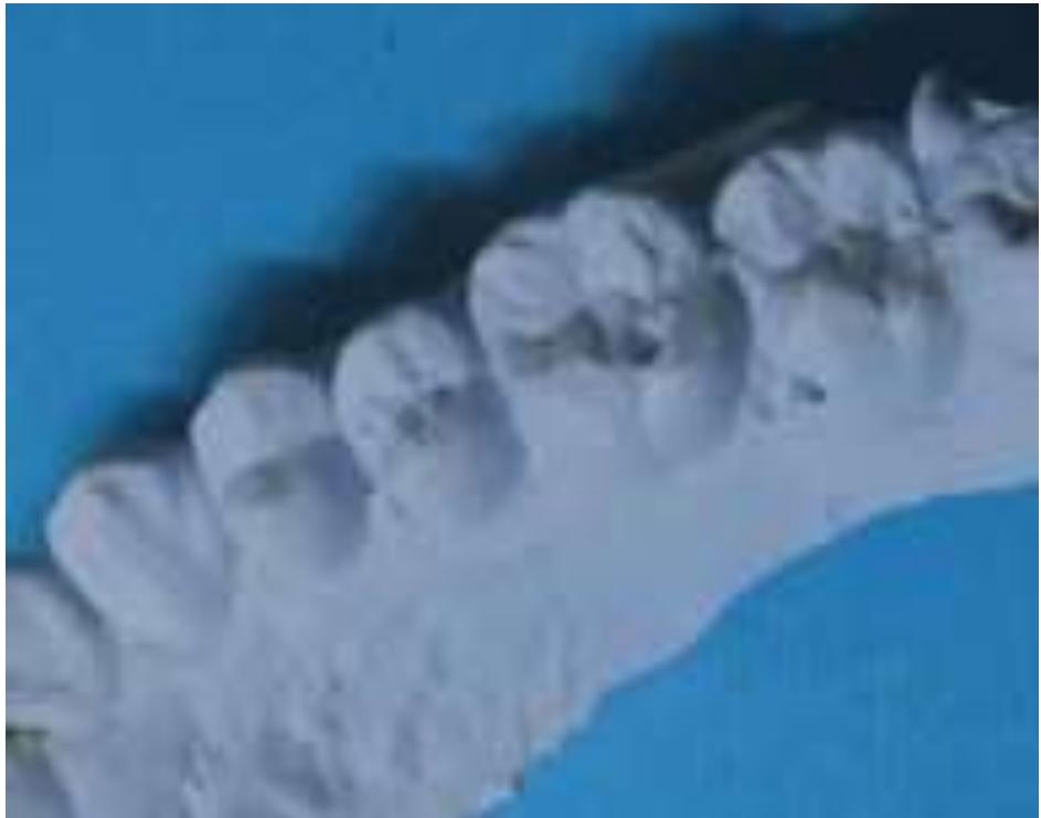 (22): a photograph of dental cast showing distal