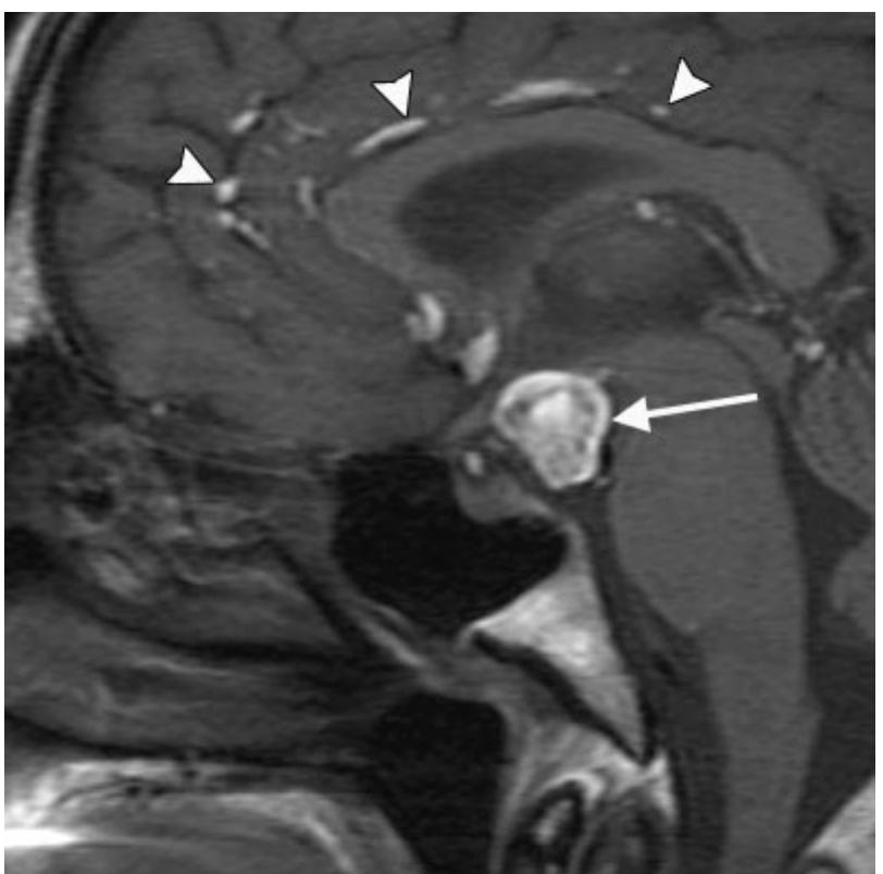 Ruptured dermoid cyst in a 50- year-old man with sudden