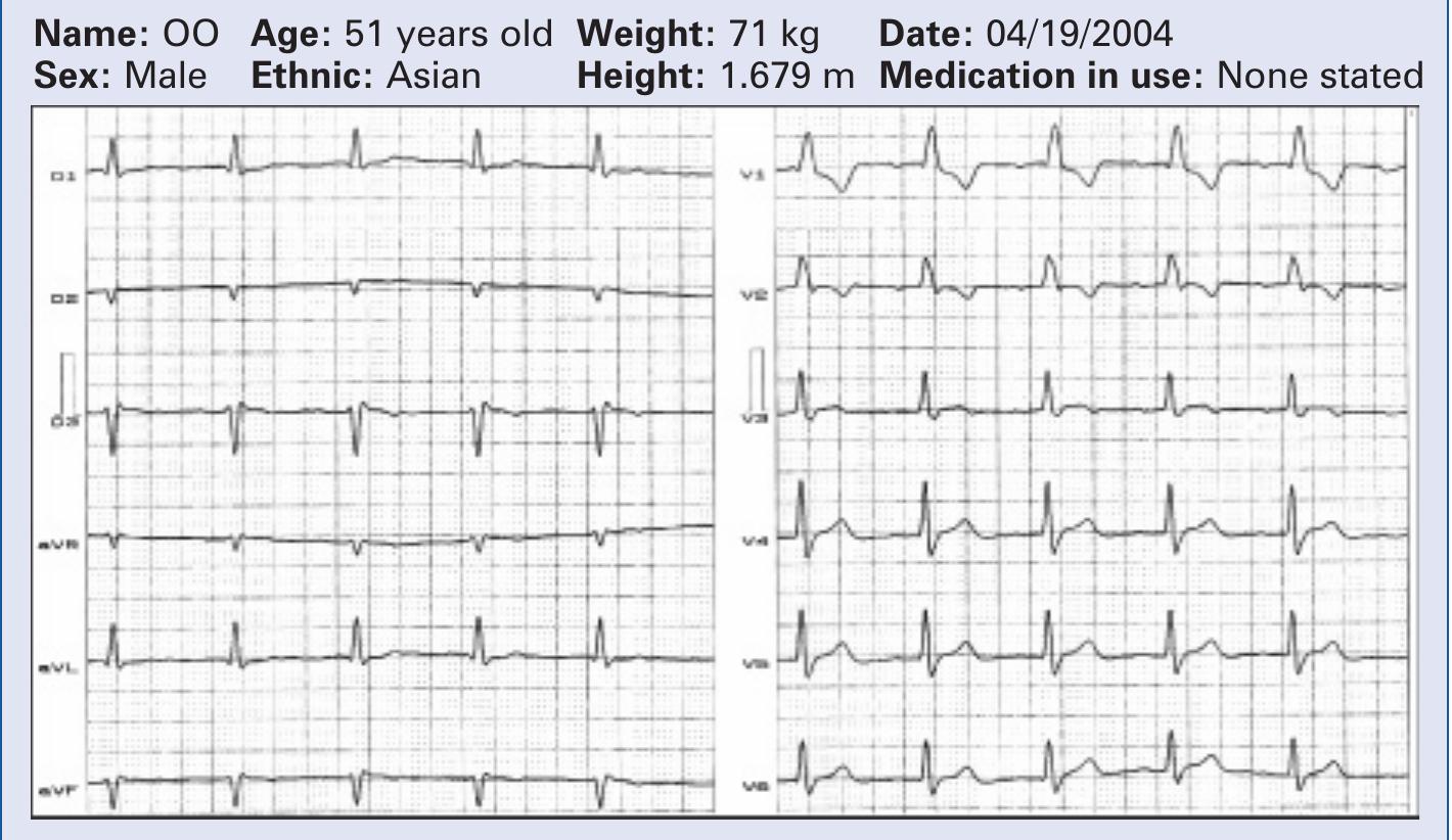 Clinical diagnosis: chronic chagasic heart disease,