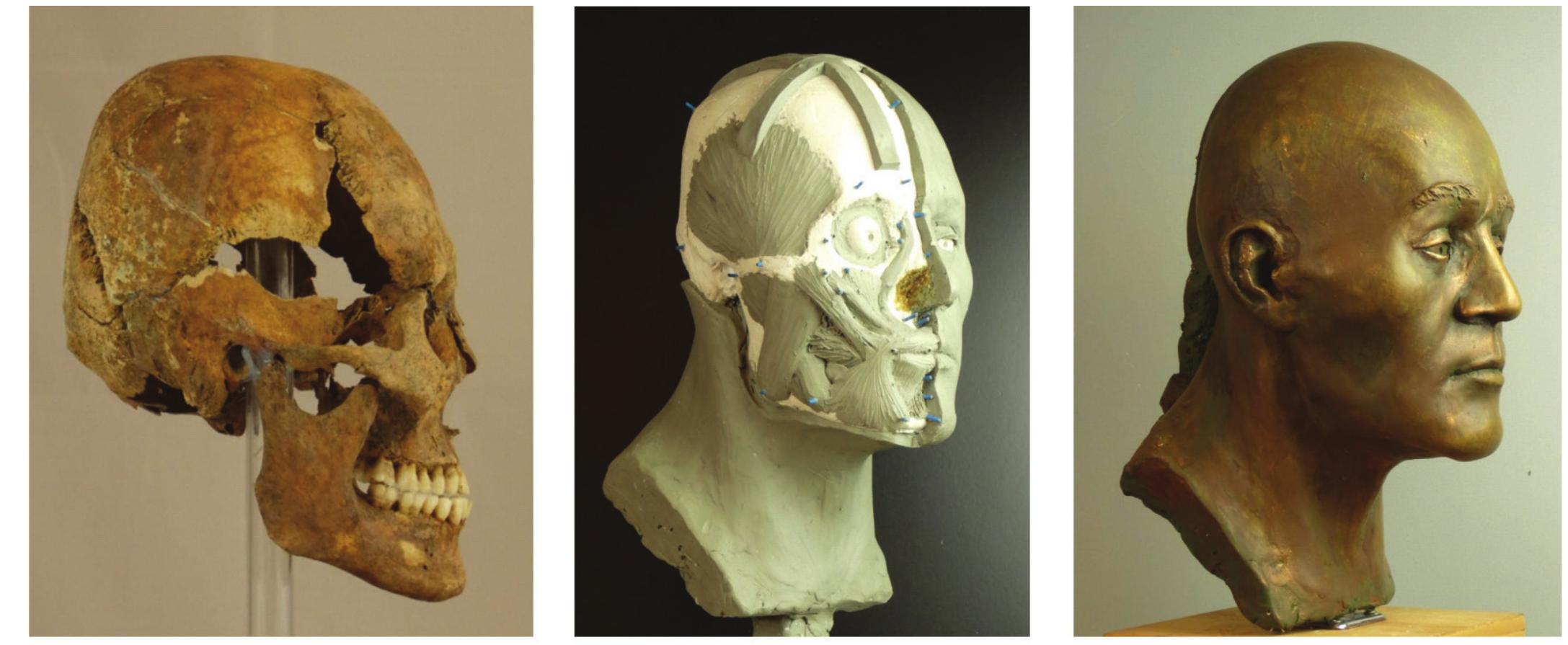 Worn mandibular central incisors and occupational stress on