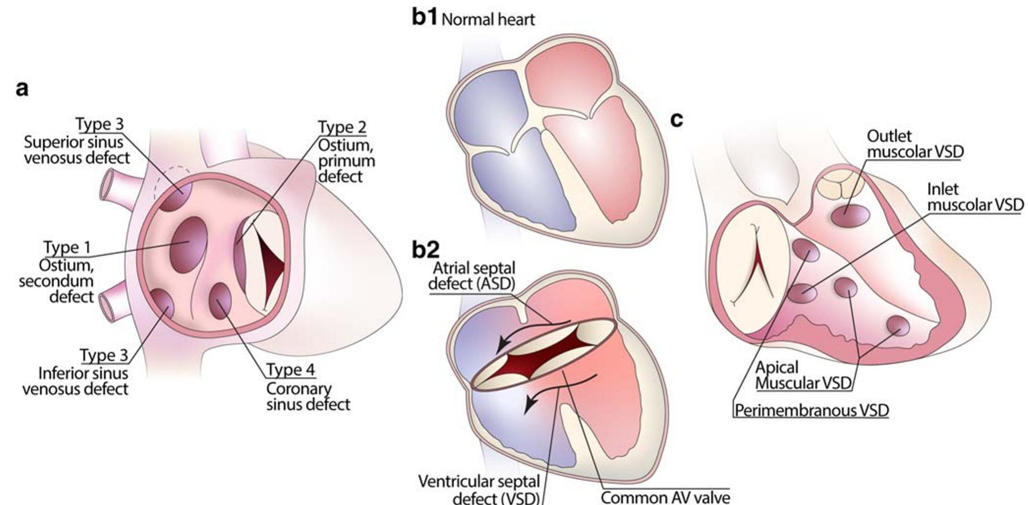 Drawings of the most common types of atrial (a),