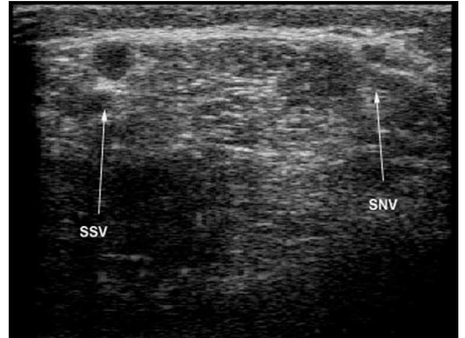 A transverse ultrasound image the popliteal area shows the