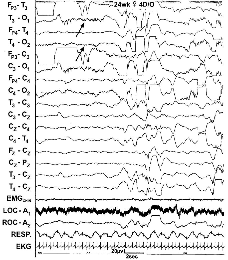 An eeg segment of a 24-week 4-day-old female with prolonged