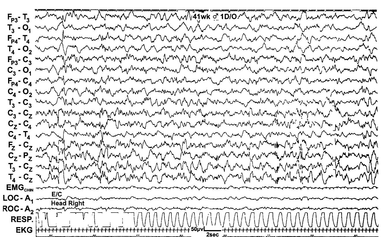 An eeg segment of a 41-week 1-day-old female that documents