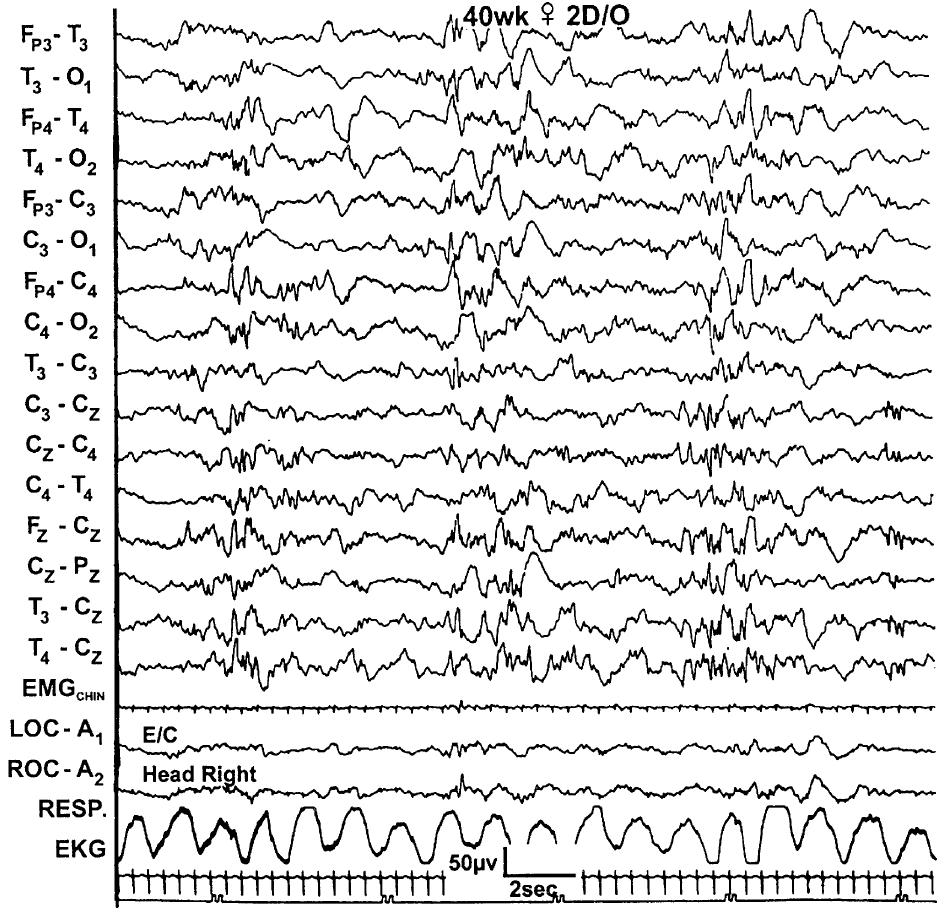 An eeg segment of a 40-week 2-day-old female, documenting a