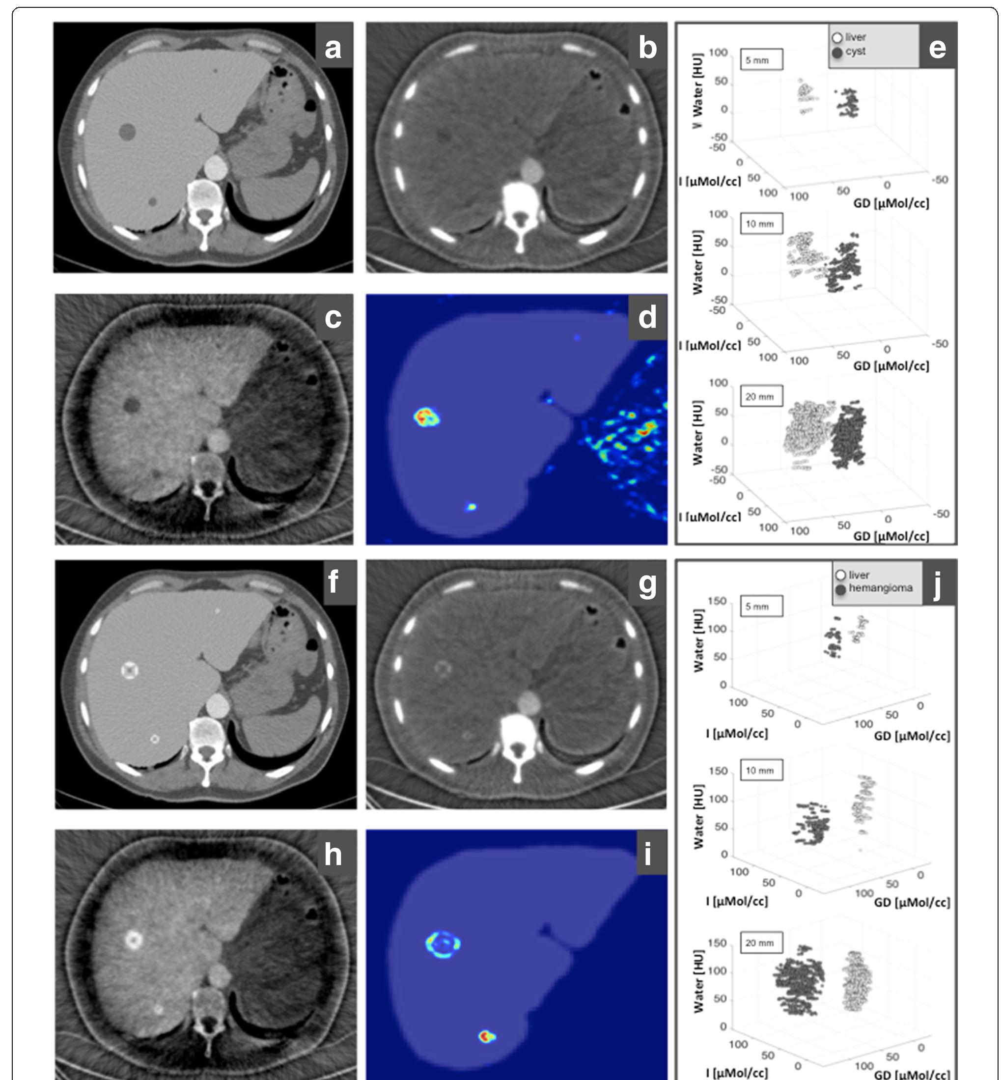 Spcct imaging of benign liver lesions, exemplified by cysts
