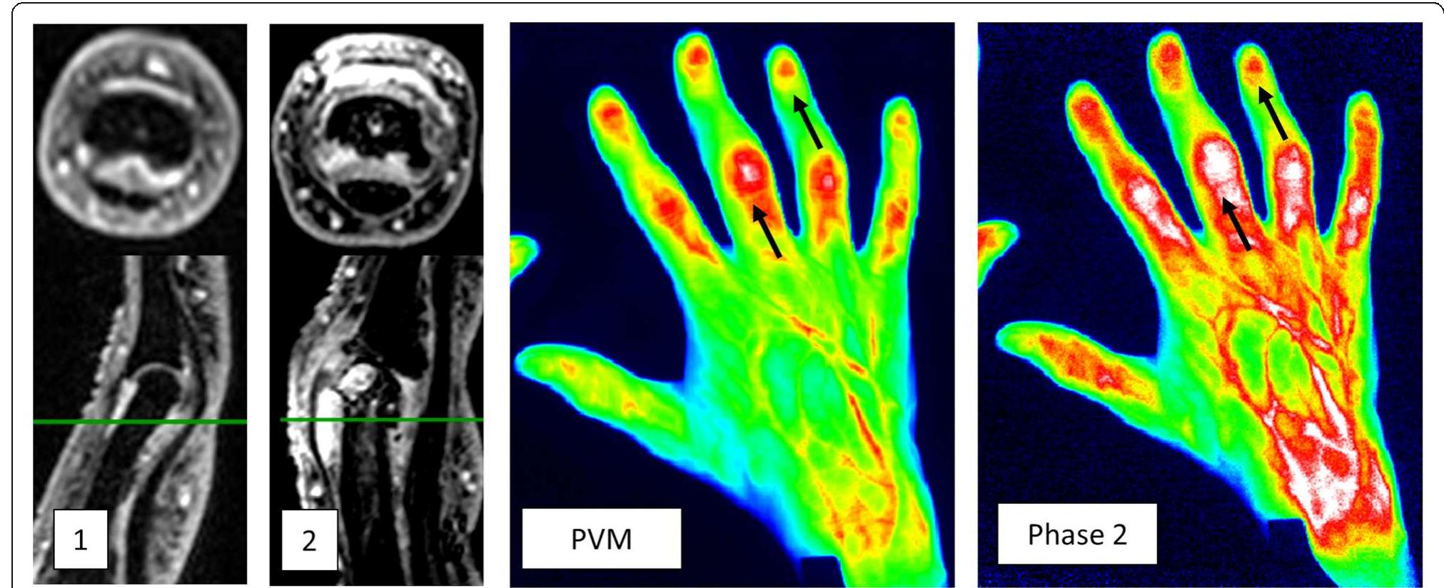 Mri synovitis grade 2 on axial and sagittal plane in dip 4