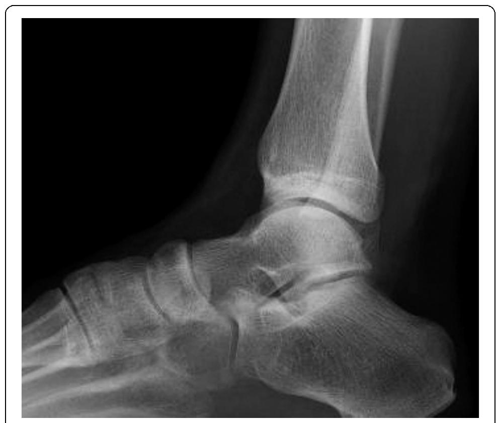 Plain radiograph of the left foot. the radiograph