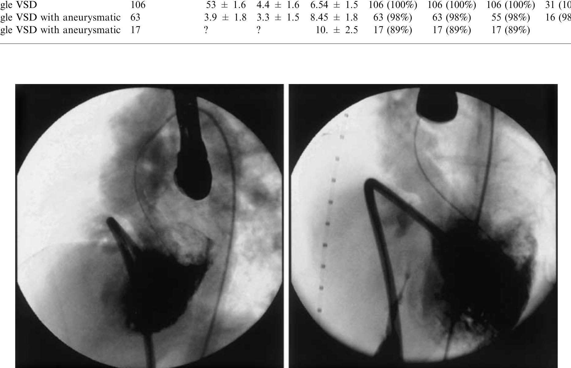 Left ventricular angiogram after long sheath placement.