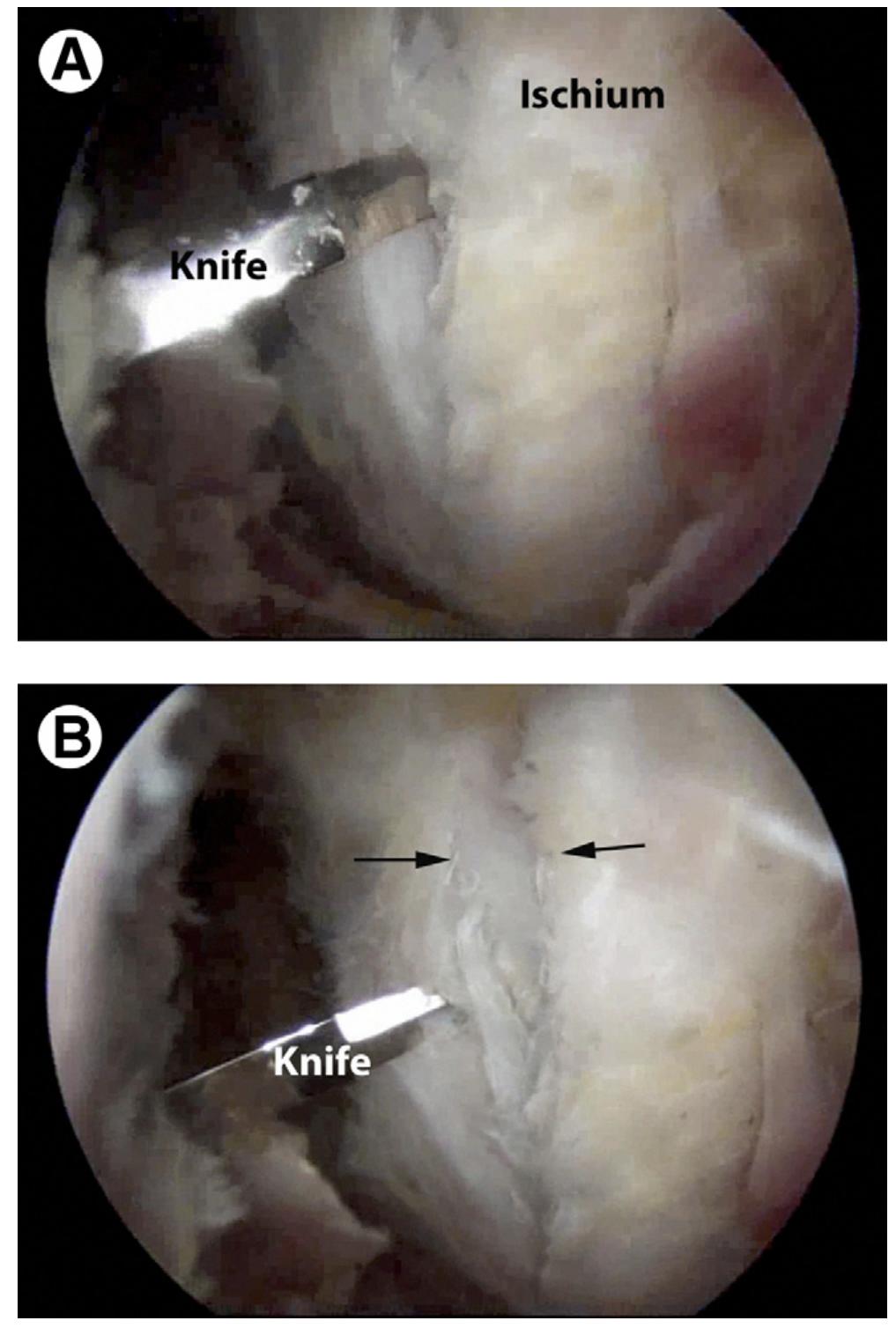 Endoscopic views of the proximal hamstring origin in a left