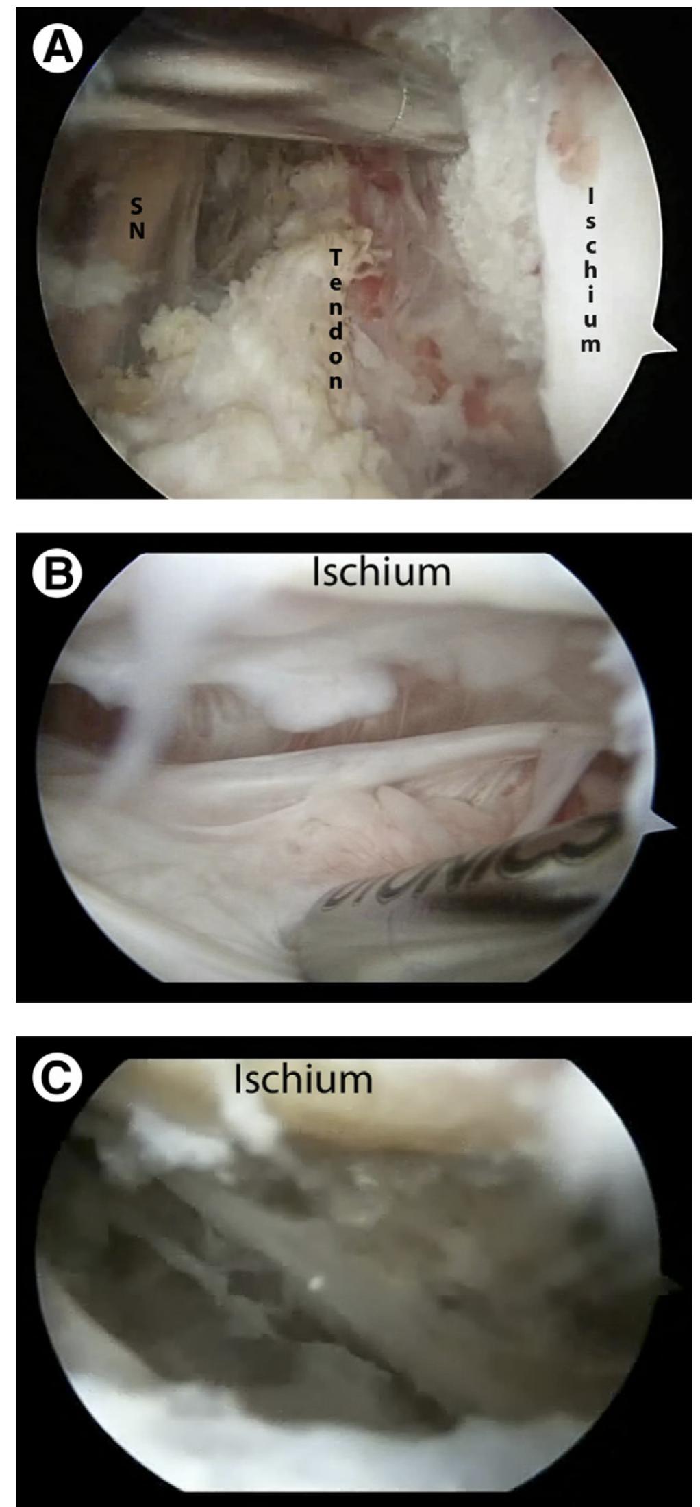 Endoscopic view of the proximal hamstring origin in a left