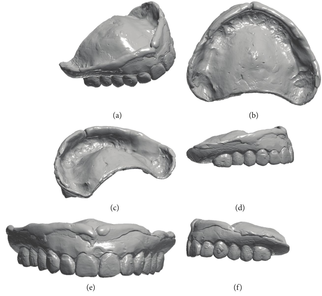 Extraoral scan of the preexisting complete removable