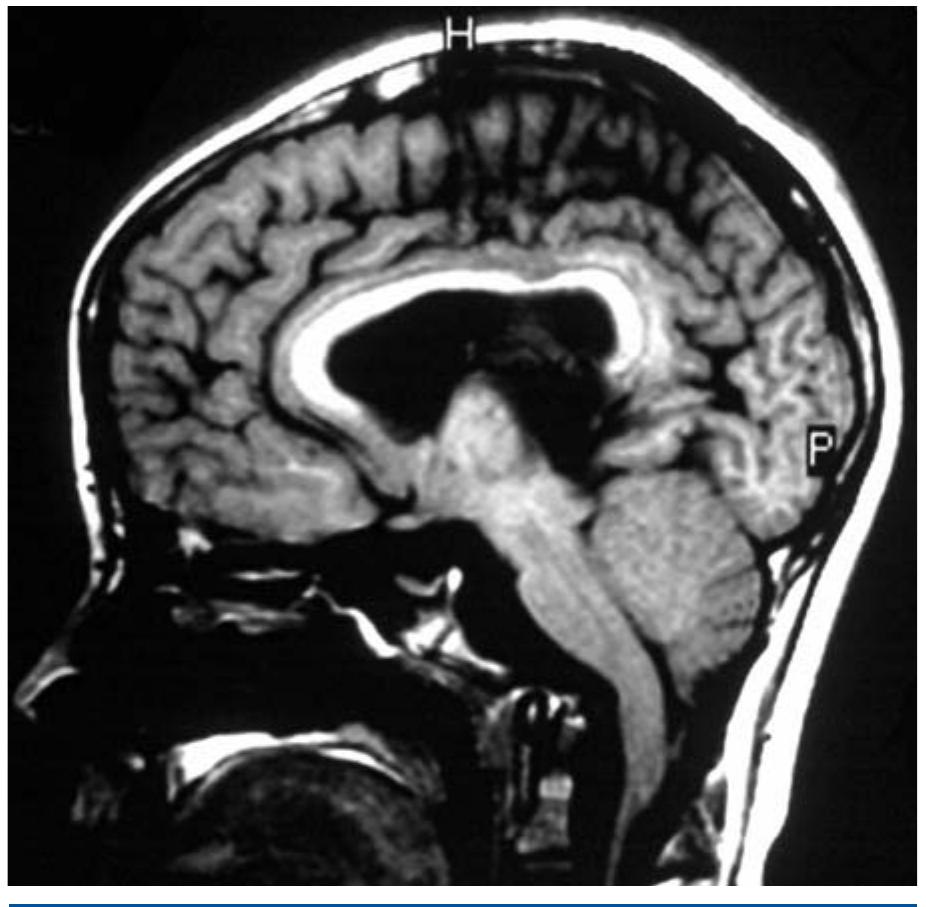 3. medullary kink. the ponto-medullary fissure is well below