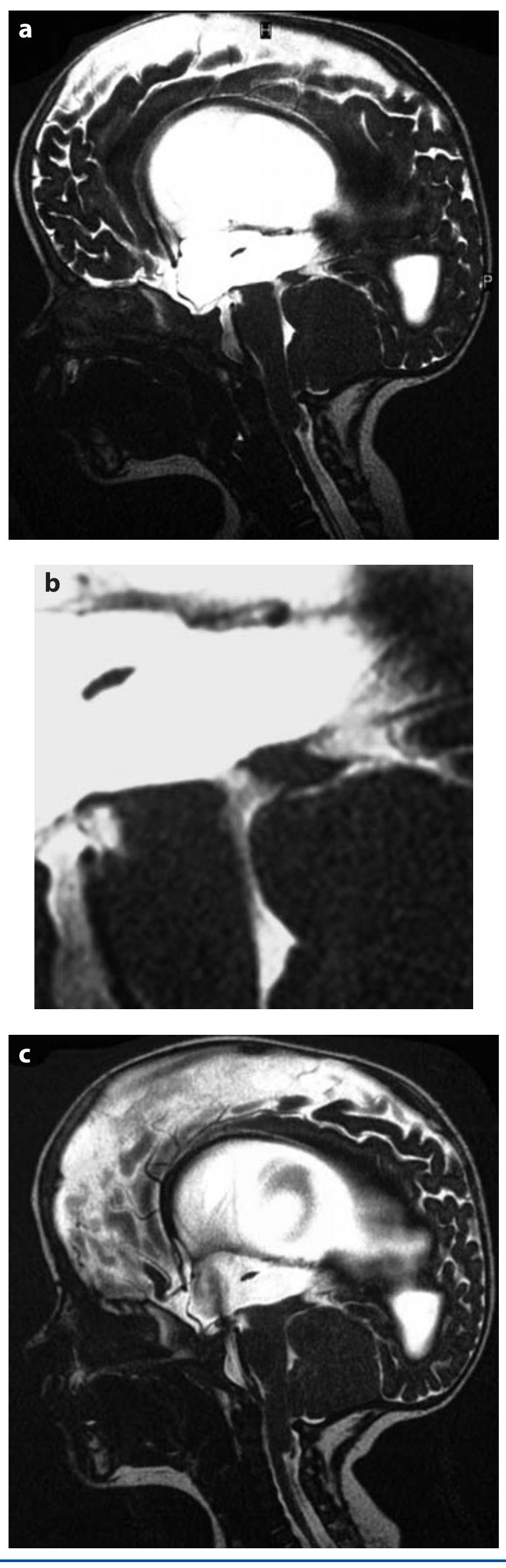 7 a, b. a six month-old baby boy with myelo- meningocele,