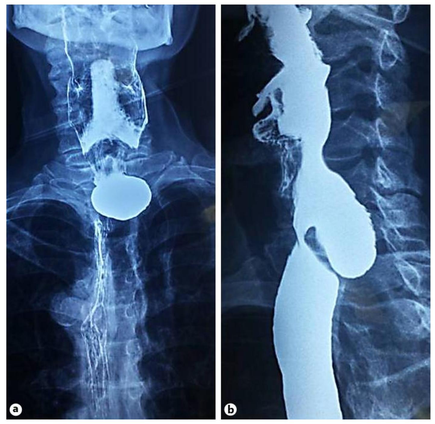 Esophagogram showing a zd: anterior-posterior view (a) and