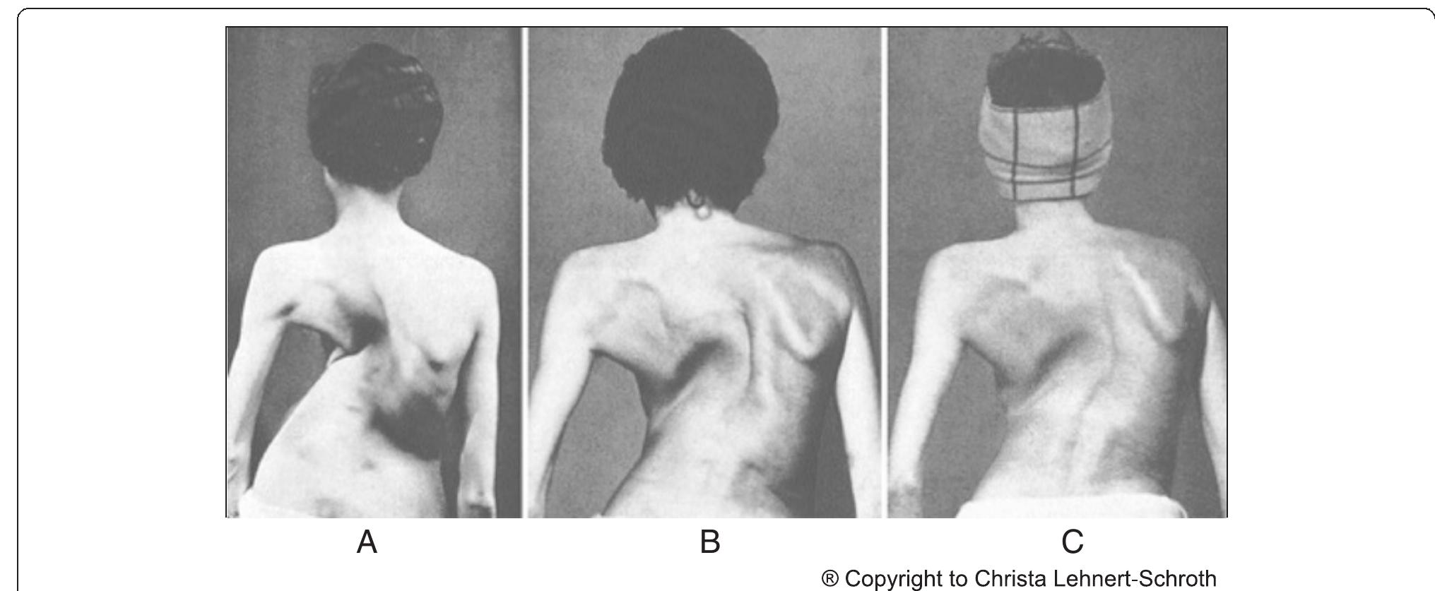 (a, b, c): severe scoliosis in a 24-year-old female patient.
