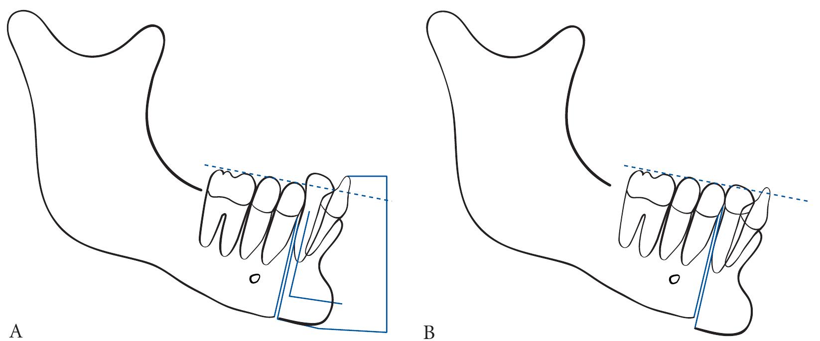 -29 a, b, bilateral mandibular body osteotomies will permit