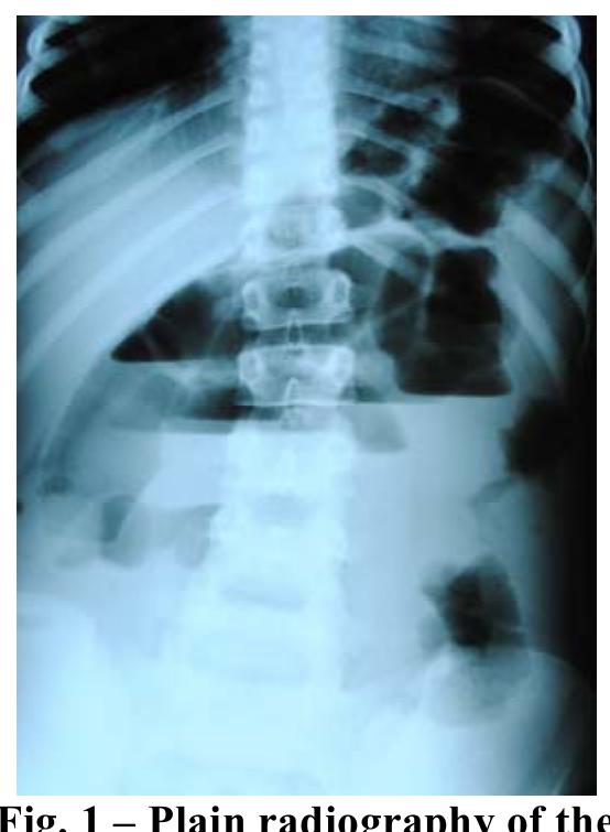 Figure 1 - from Burkitt lymphoma as a cause of