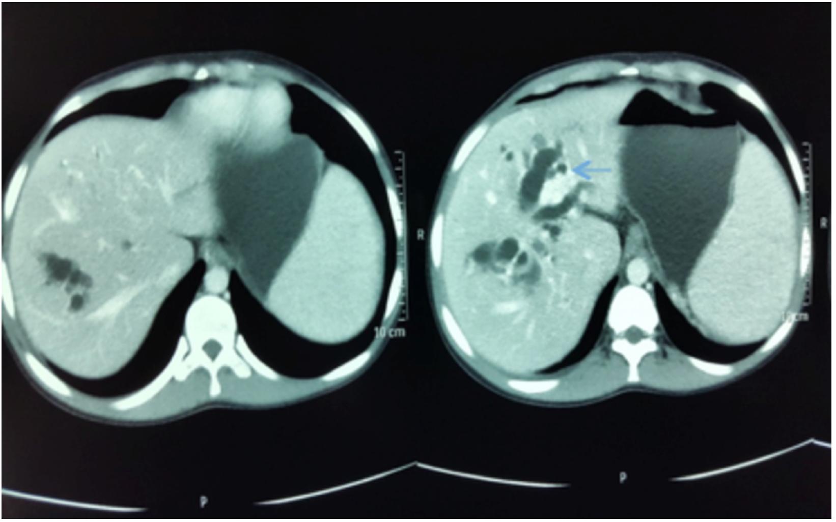 Intra hepatic biliary duct was grossly dilated and cystic