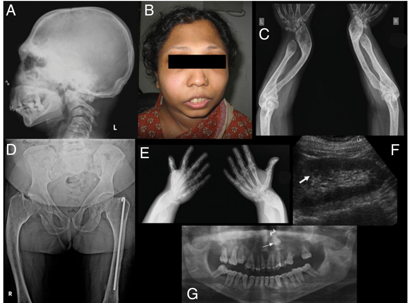 Radiographs of patient 2 showing massive sclerosis of the