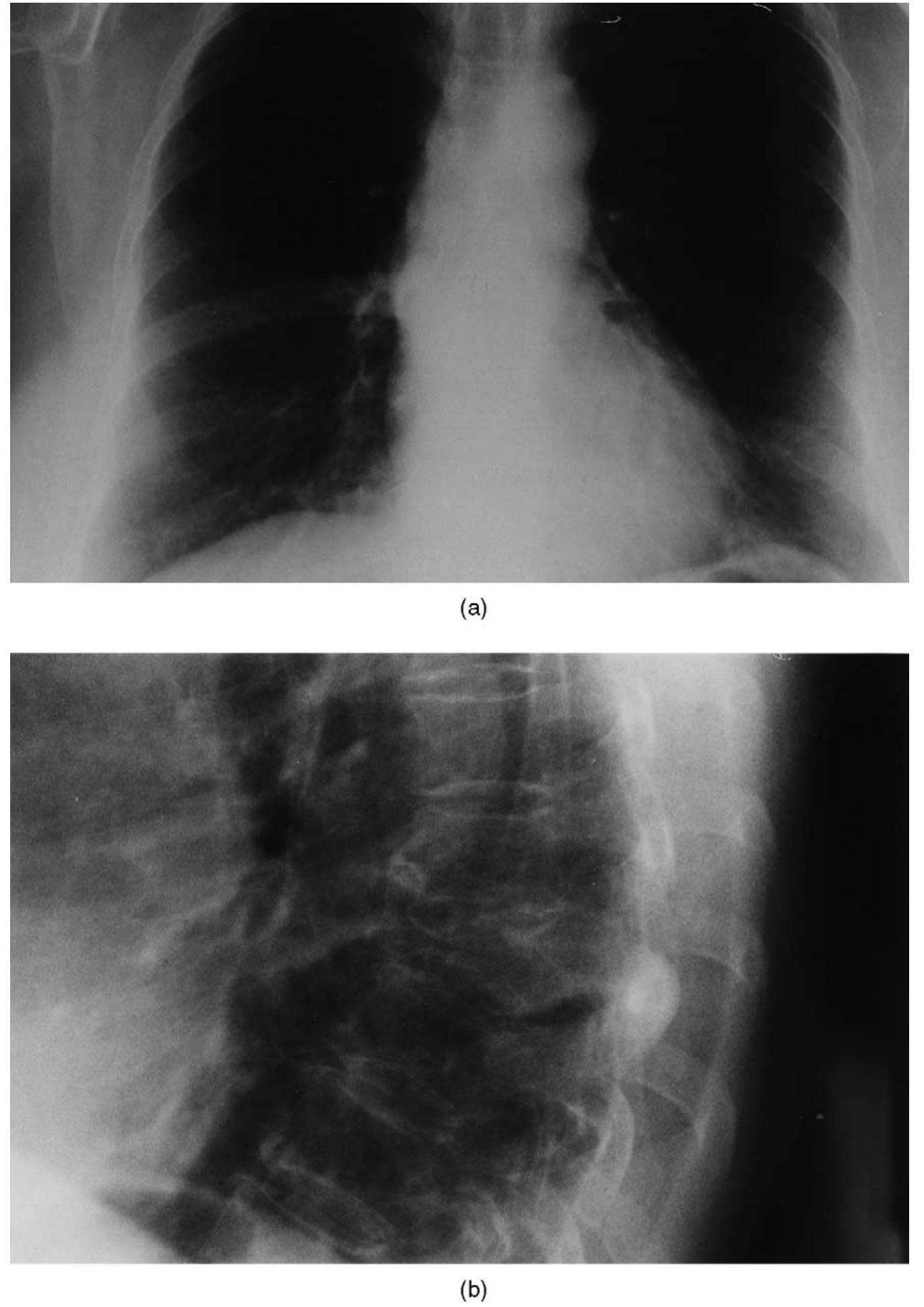 (a) postero-anterior chest radiograph shows sclerosis of the