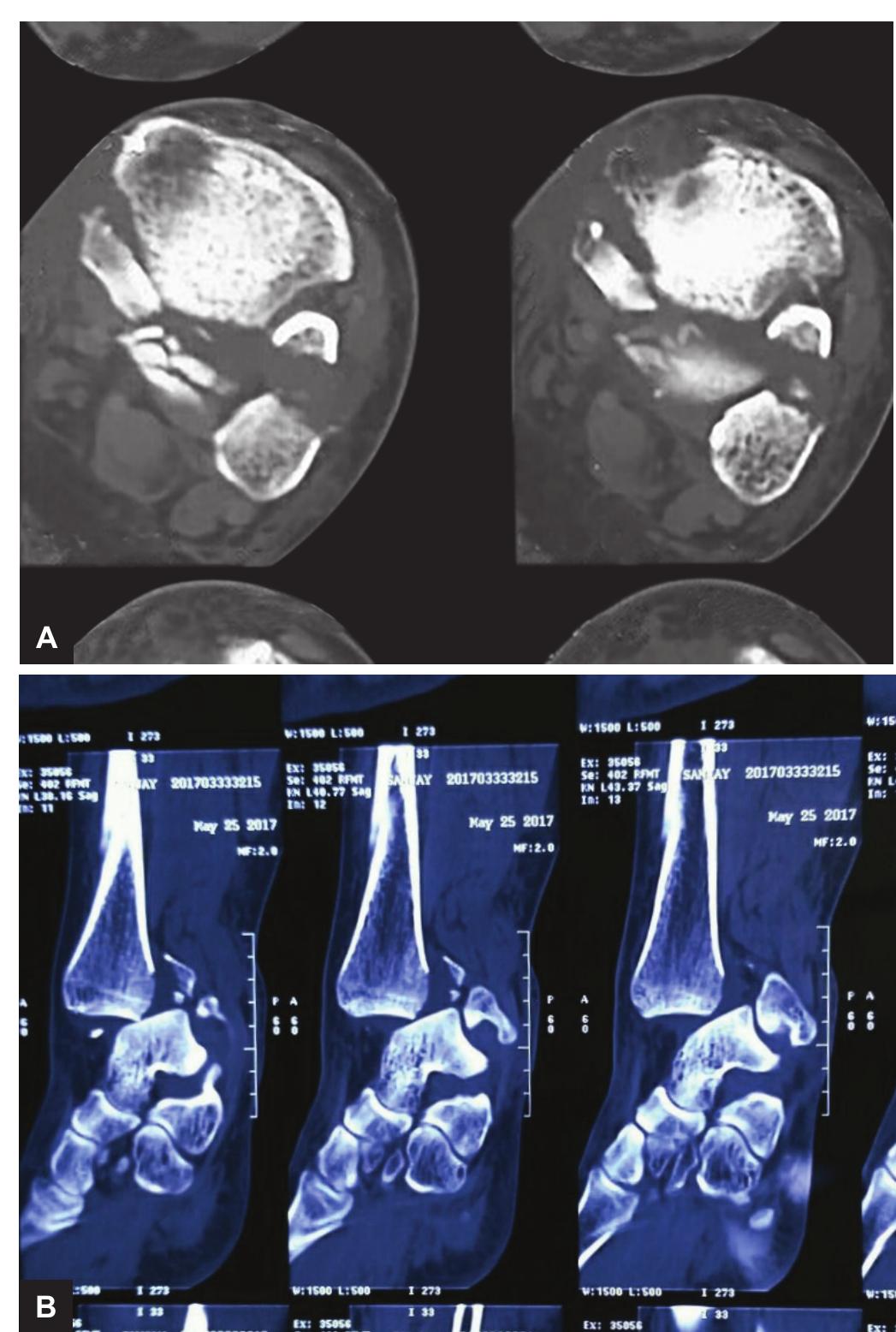 S 3a and b: the ct scan images: axial cuts (a) and sagittal