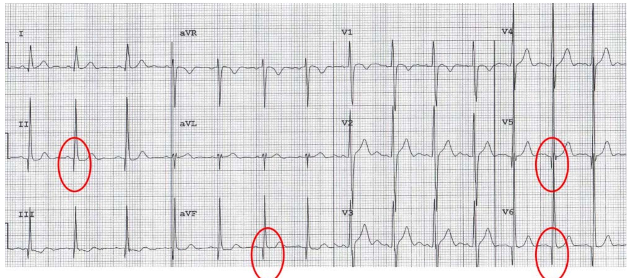 Abnormal ecg in a patient with hypertrophic cardiomyopathy.