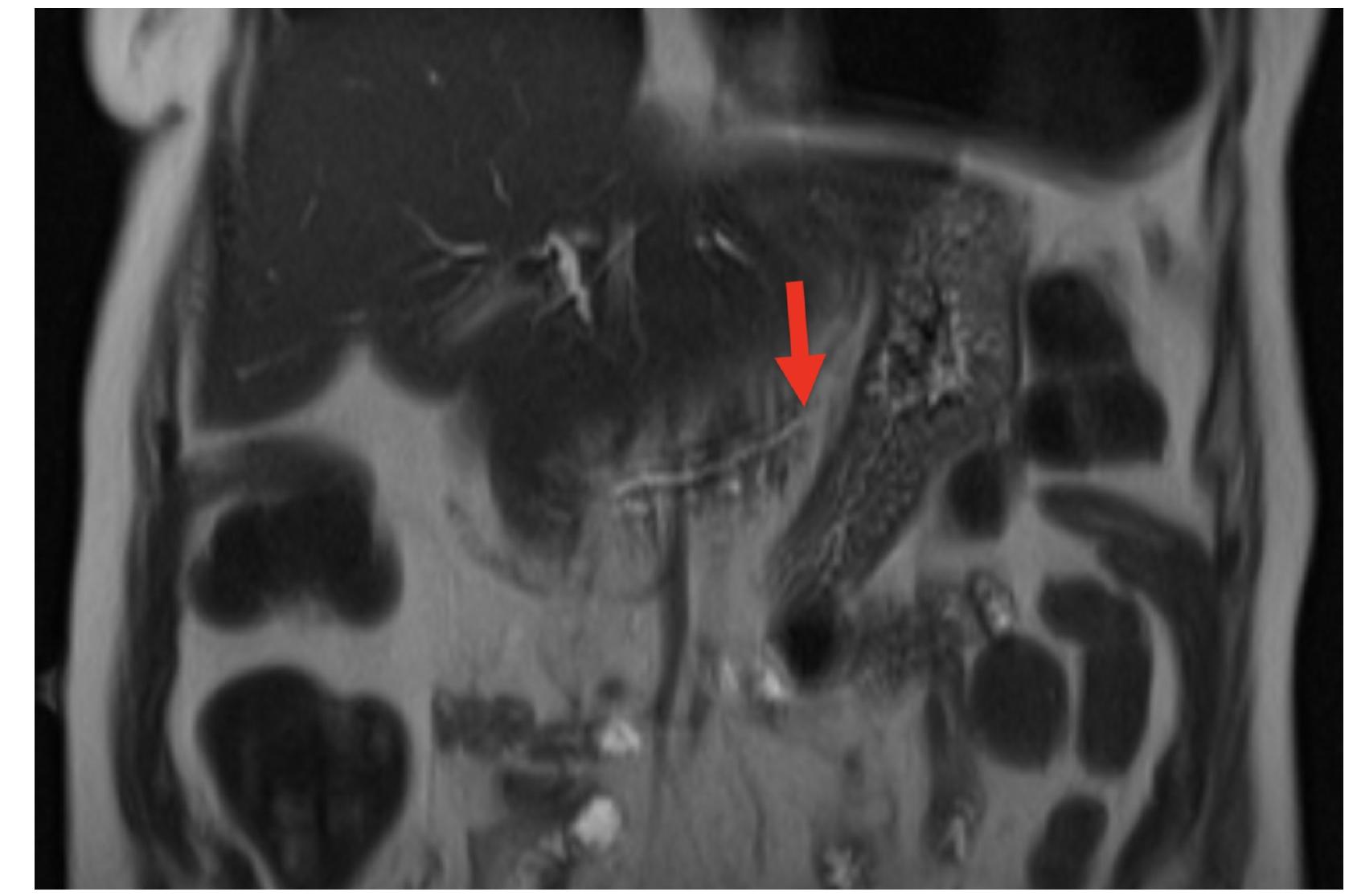 Mrcp in coronal view showing a narrow pancreatic duct