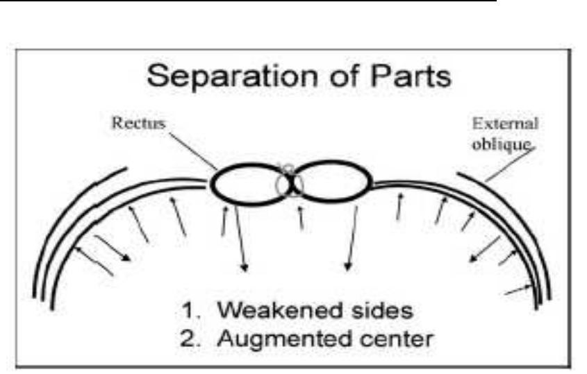 Schematic diagram of the abdominal forces after separation