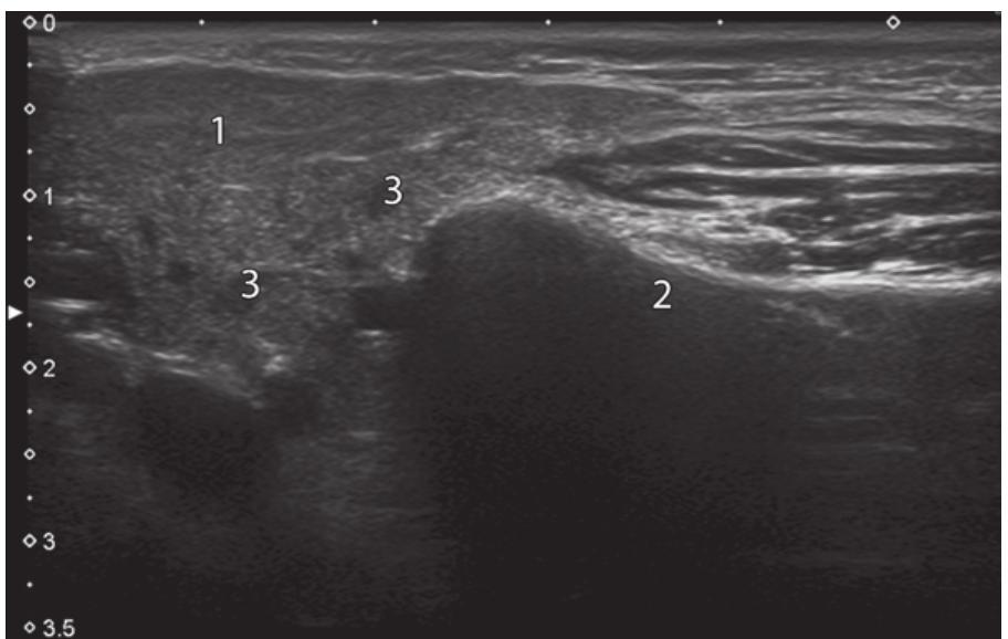 Normal parotid gland at us. transverse us image shows a