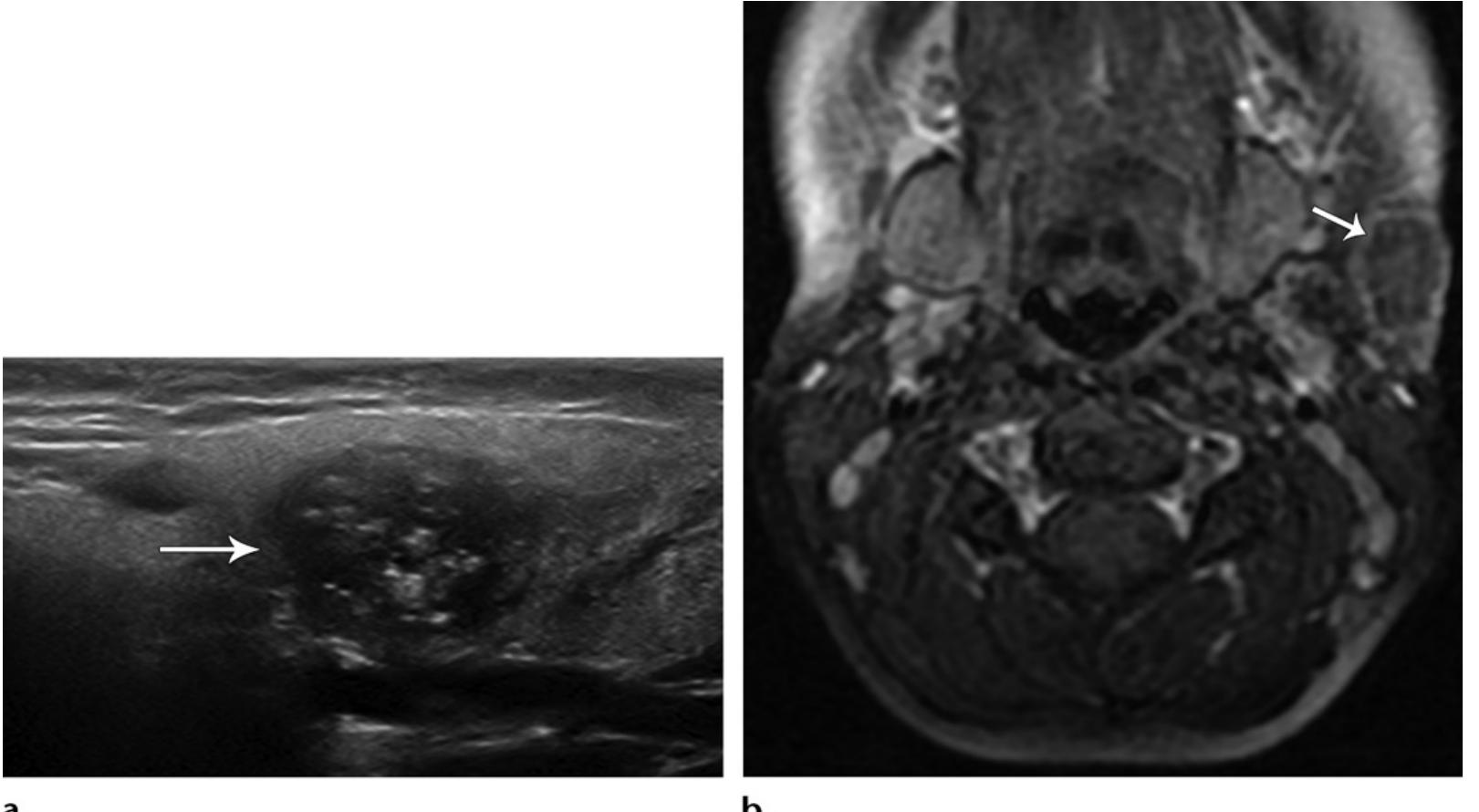Tuberculosis of the parotid gland in a 13-year-old boy. (a)