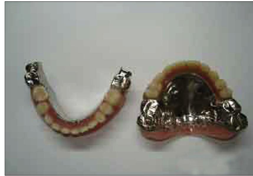 Finished maxillary and mandibular fixed removable cast