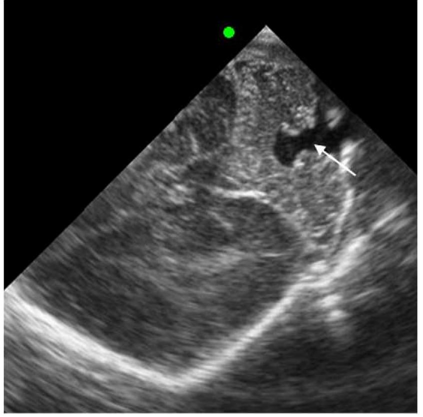 Figure 8 - Neonatal cranial ultrasonography: How to optimize