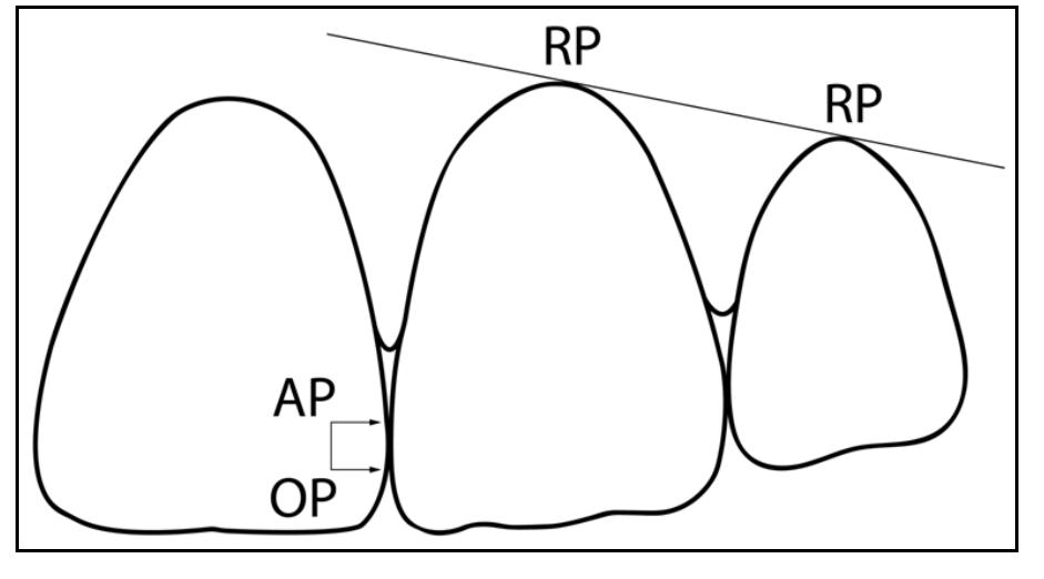 Ure 1. measurement of interproximal area (ap - op) and width