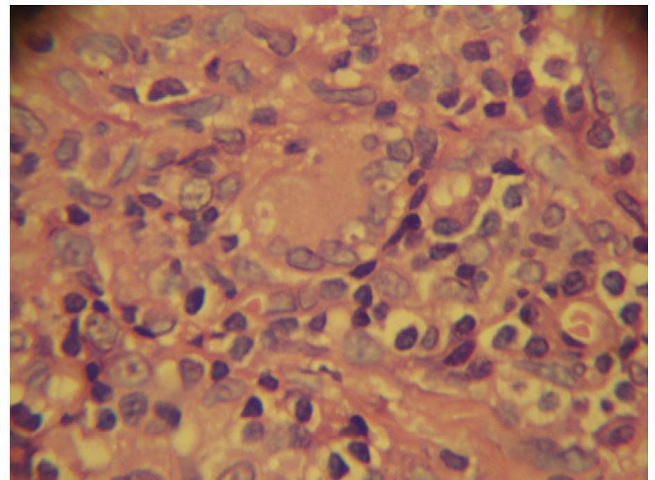 Figure 3 - A nonhealing ulcer of mandibular alveolar ridge