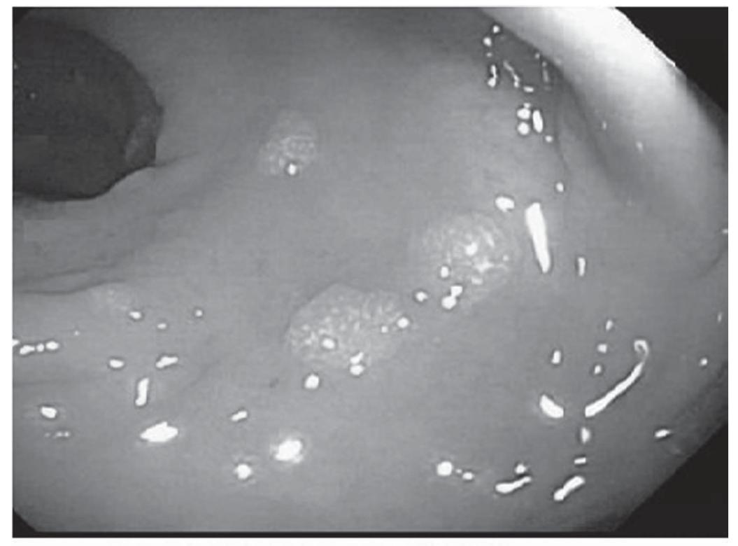 Picture 1. polyps in the sigmoid colon. purpose: