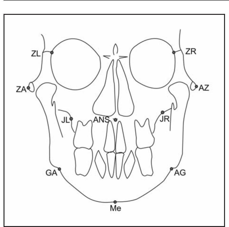 Cephalometric norms from posteroanterior ricketts