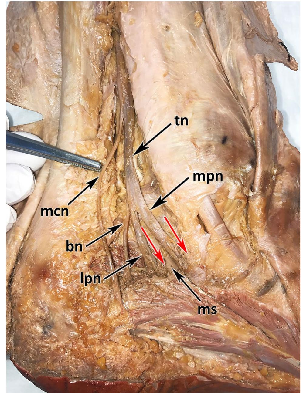 Anatomical dissection of the tibial nerve and its branches