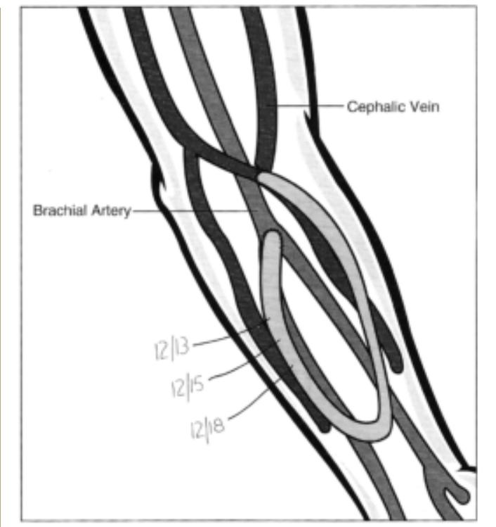 Bedside cannulation chart, show- ing dates and locations of