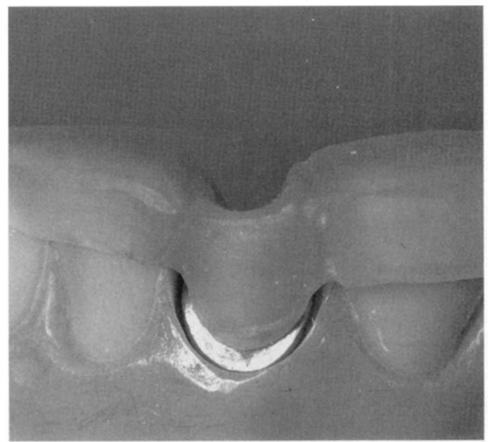 Figure 9 - Positioning jig for implant abutments: Procedures