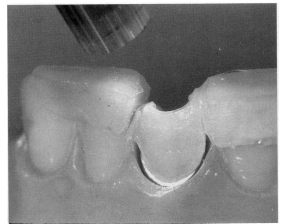 Figure 11 - Positioning jig for implant abutments: