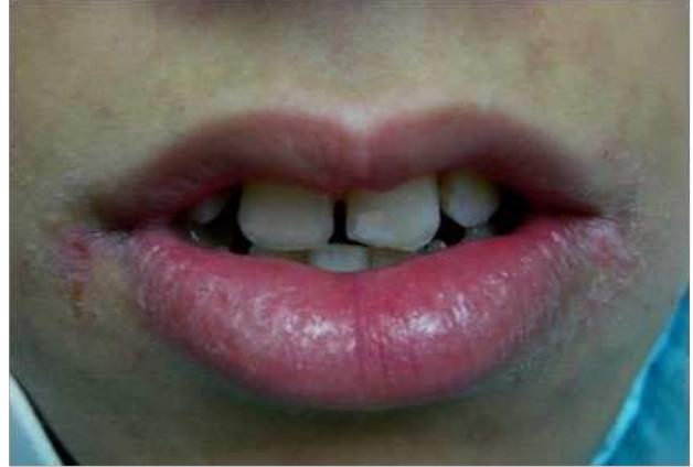 Pdf Angular Cheilitis An Updated Overview Of The Etiology Diagnosis And Management Research