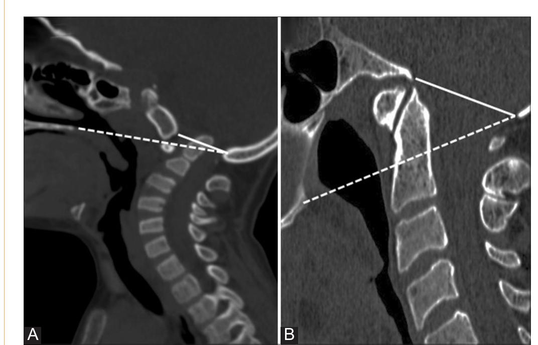 (a and b): sagittal ct images (a) and (b) showing group a