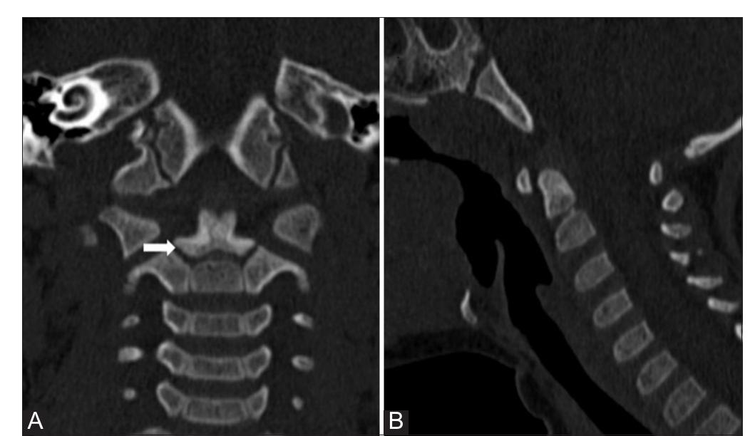 Figure 8 - CT and MR imaging of odontoid abnormalities: A